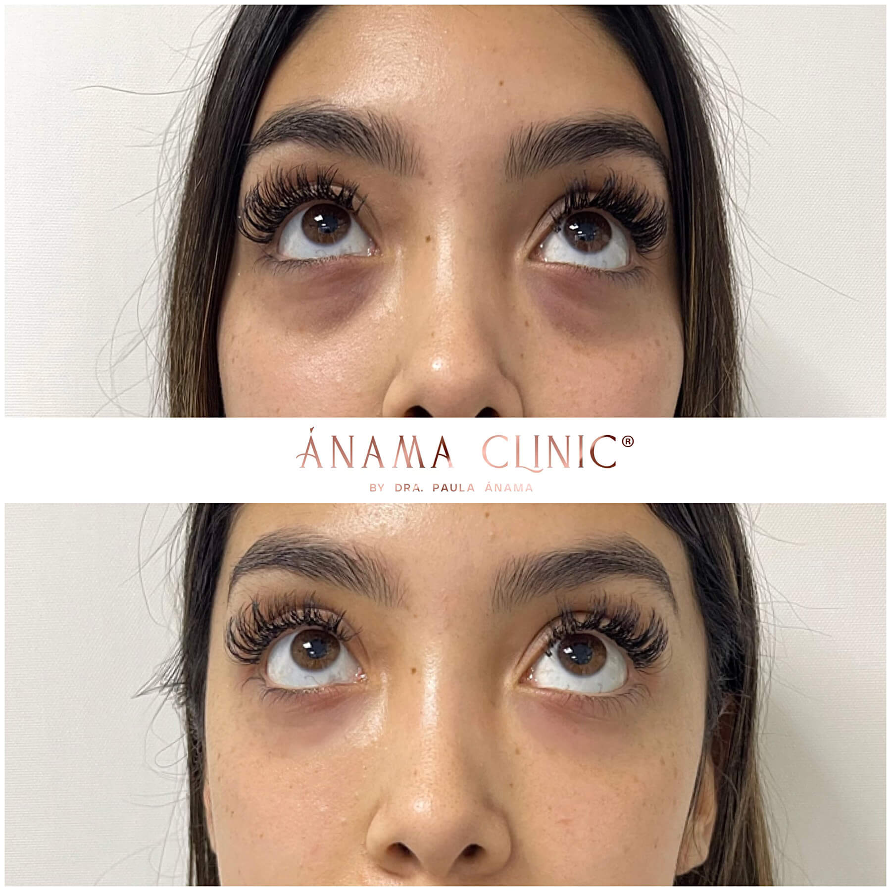 Tratamiento de ojeras - Ánama Clinic